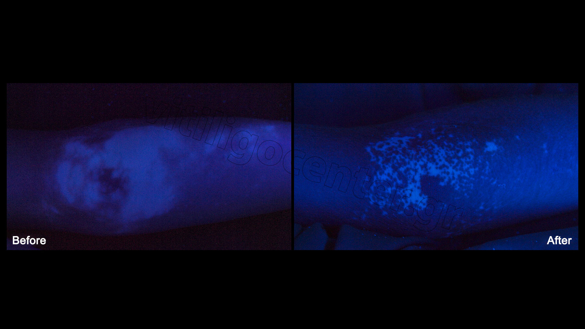 Cases Of Vitiligo On The Upper And Lower Limbs Vitiligo Center