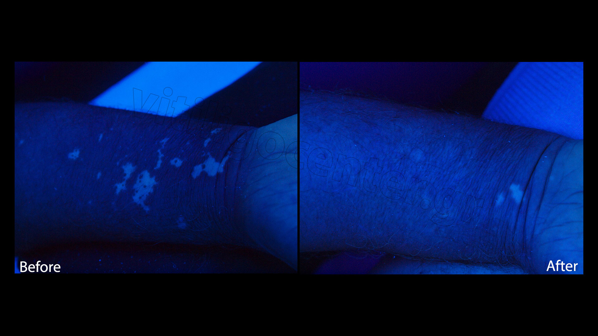 Cases Of Vitiligo On The Upper And Lower Limbs Vitiligo Center