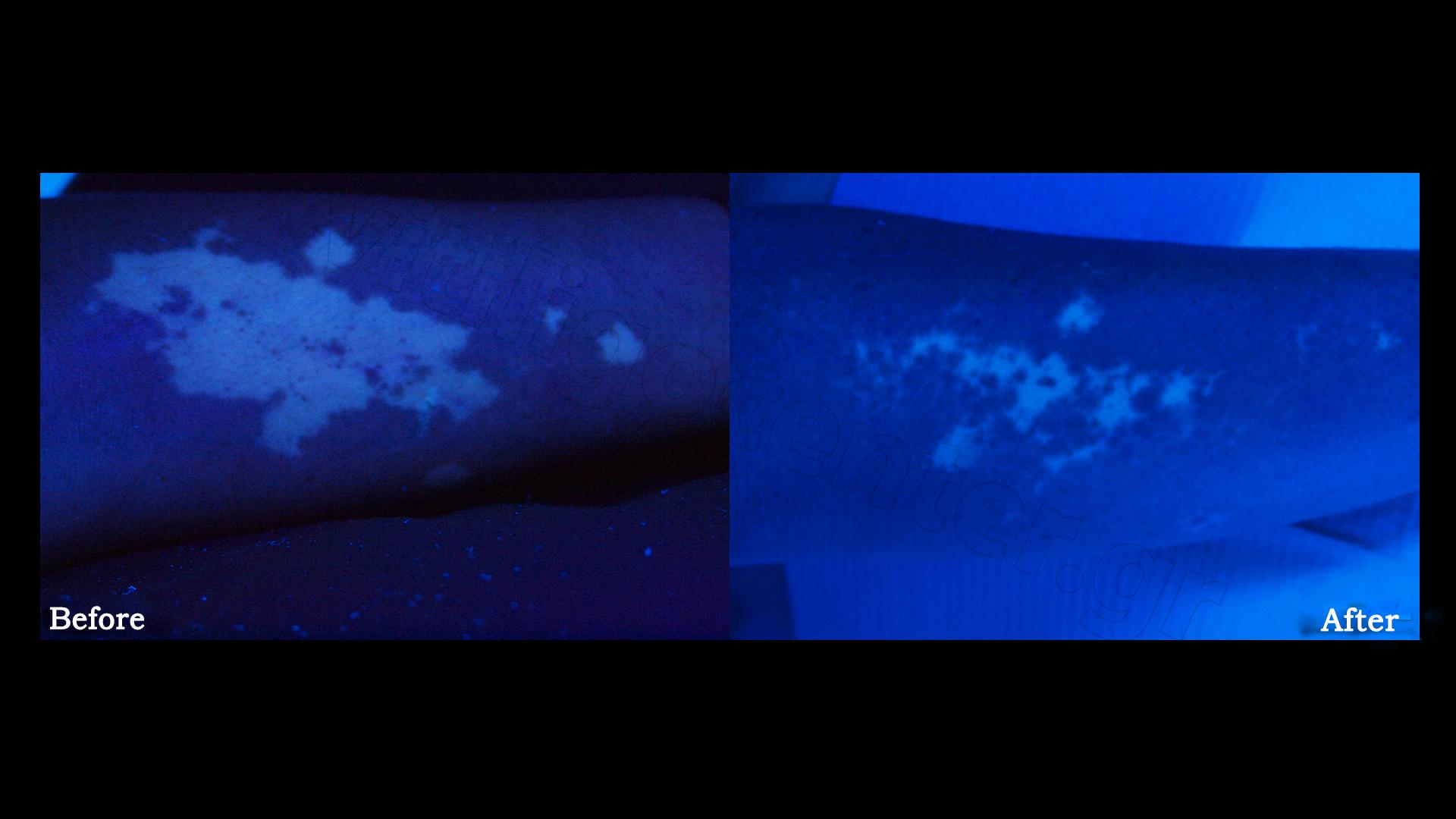 Cases of vitiligo on the upper and lower limbs | Vitiligo Center ...