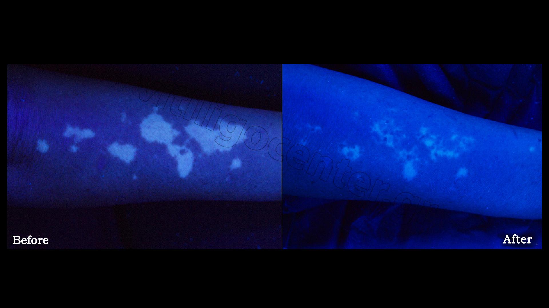 Cases of vitiligo on the upper and lower limbs | Vitiligo Center ...