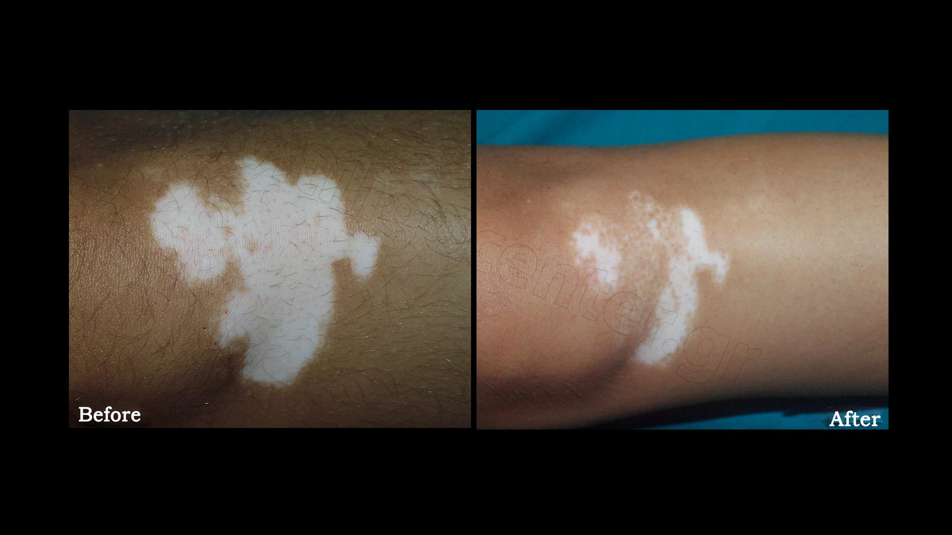 Cases of vitiligo on the upper and lower limbs | Vitiligo Center ...