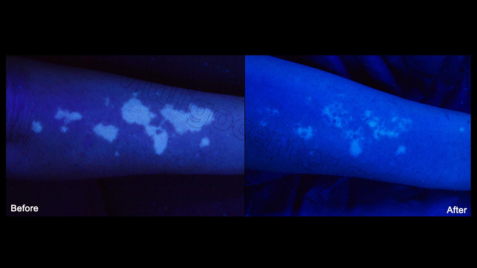 Cases of vitiligo on the upper and lower limbs | Vitiligo Center ...